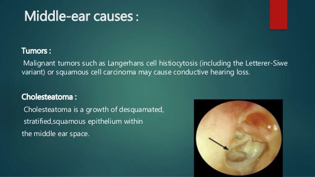 Conductive hearing loss