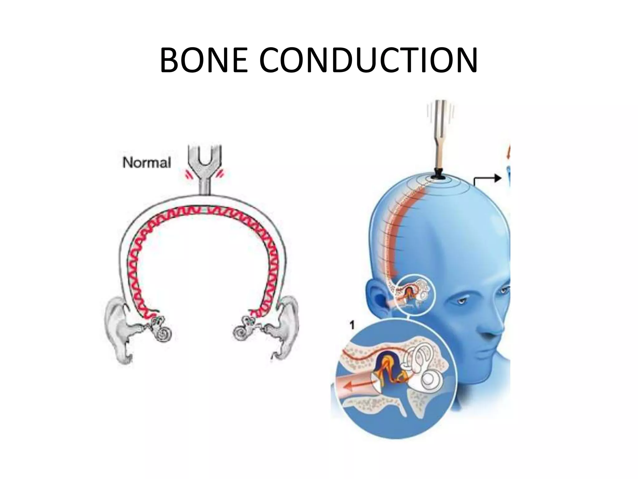 Conductive hearing loss | PPTX