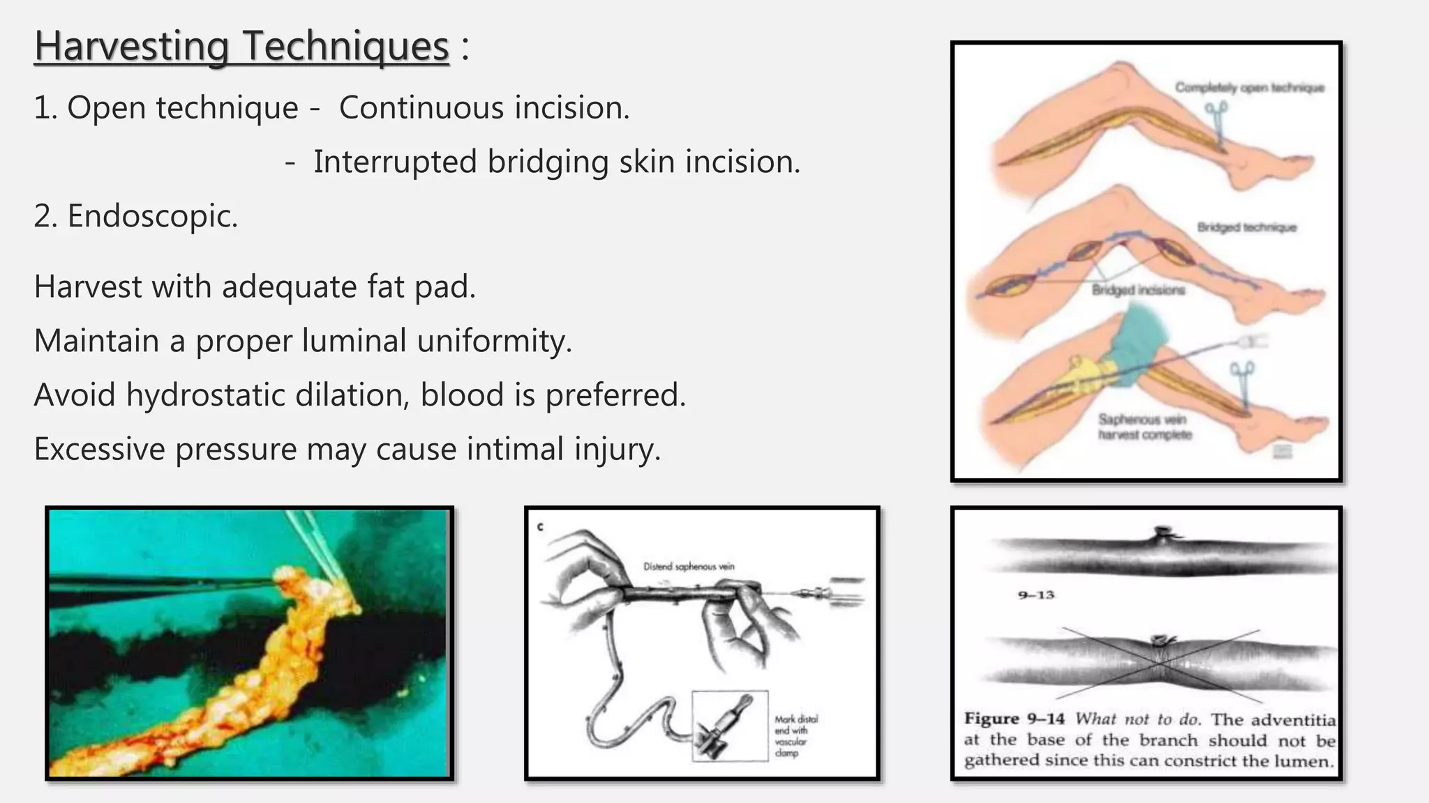 Conduits used in CABG. | PPTX