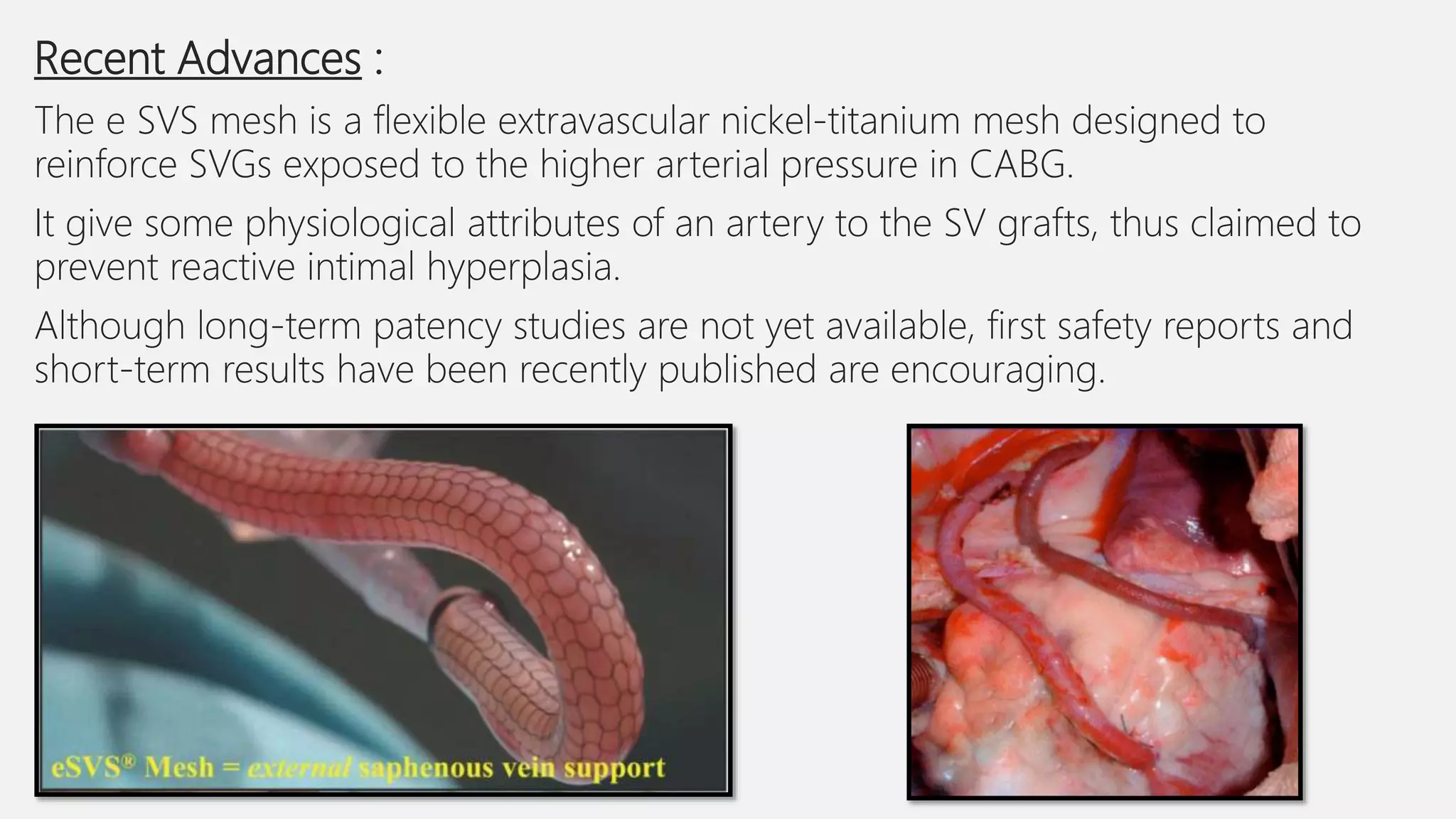 Conduits used in CABG. | PPTX