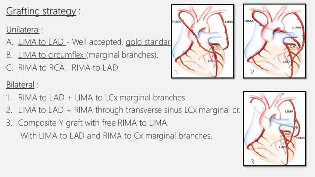 Conduits used in CABG. | PPTX