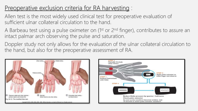 Conduits used in CABG. | PPTX