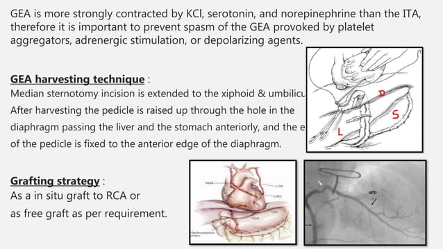 Conduits used in CABG. | PPTX