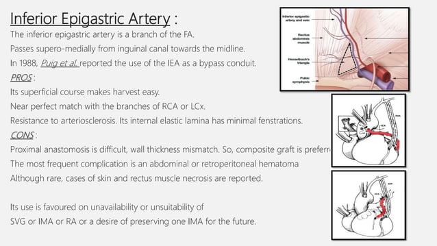 Conduits used in CABG. | PPTX