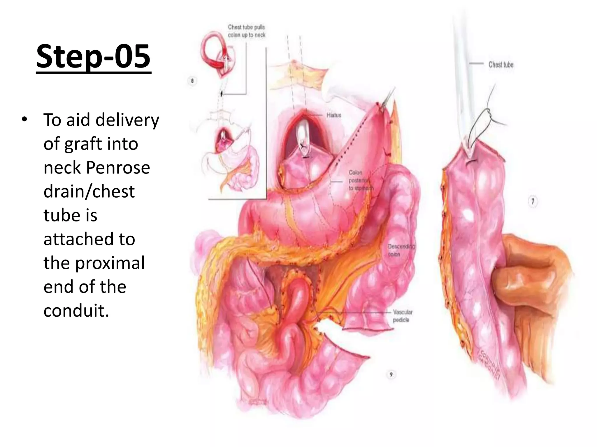 Conduits after esophagectomy for esophageal reconstruction | PPTX