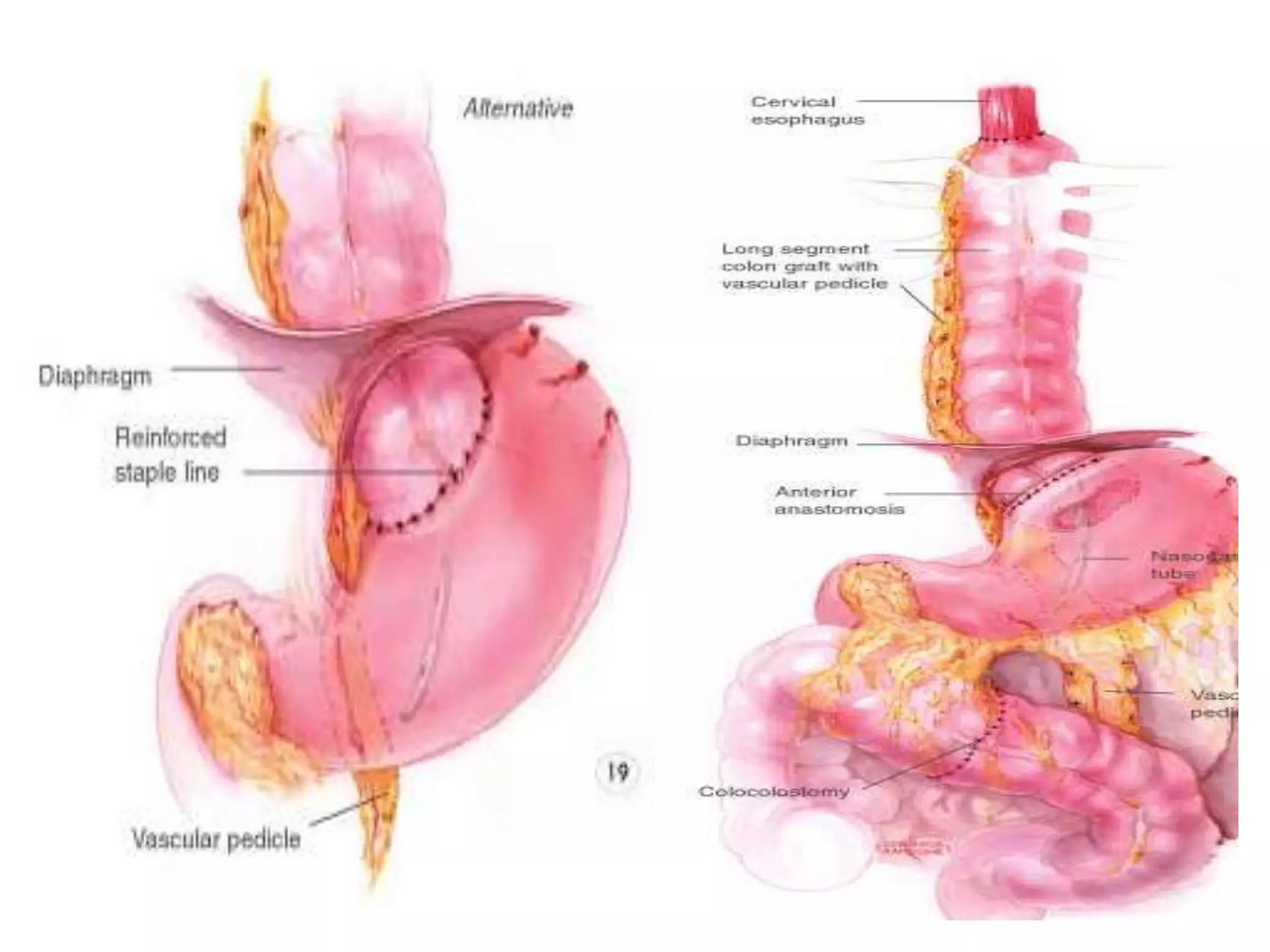 Conduits after esophagectomy for esophageal reconstruction | PPTX