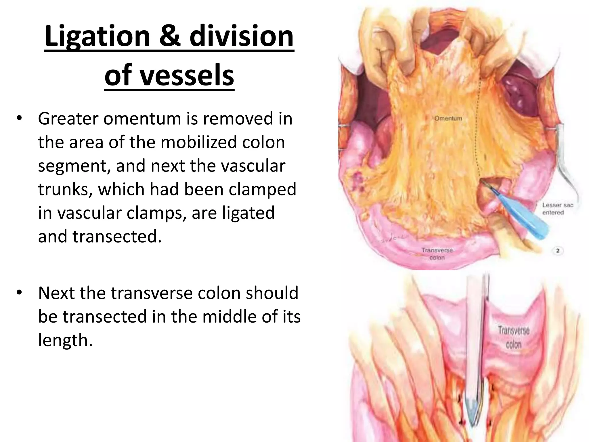 Conduits after esophagectomy for esophageal reconstruction | PPTX