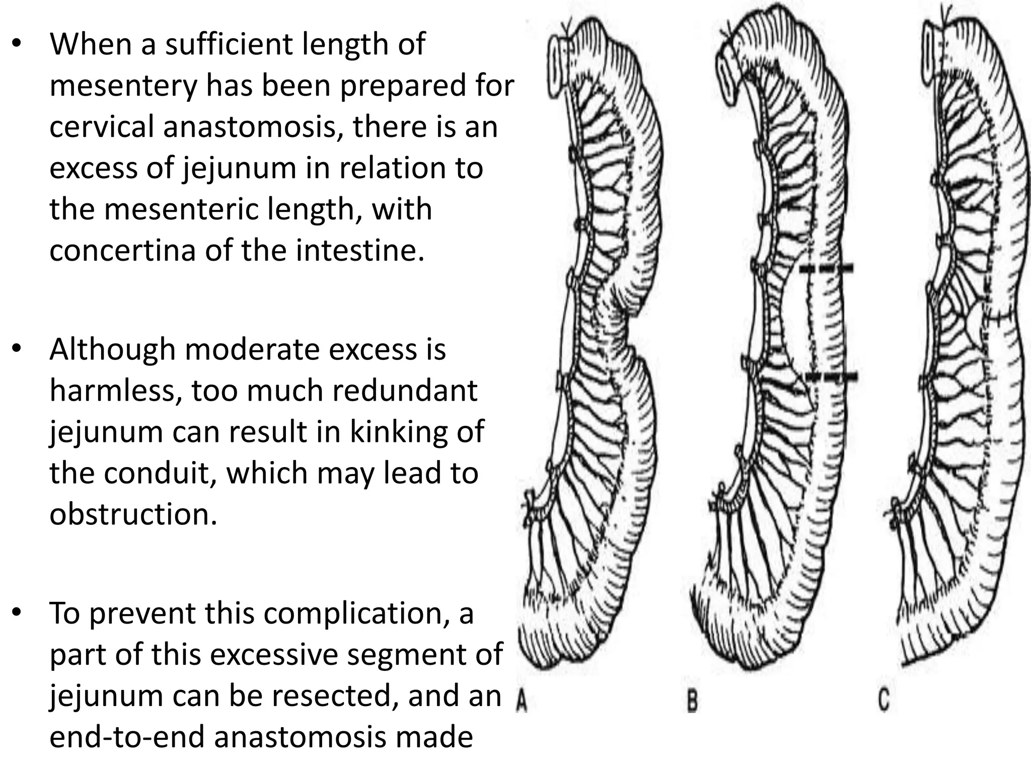 Conduits after esophagectomy for esophageal reconstruction | PPTX