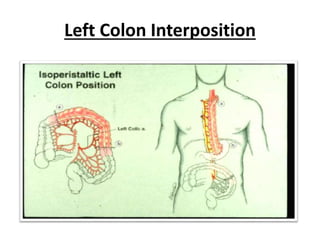 Conduits after esophagectomy for esophageal reconstruction | PPTX