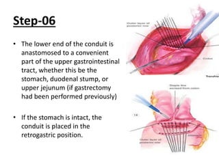 Conduits after esophagectomy for esophageal reconstruction | PPTX