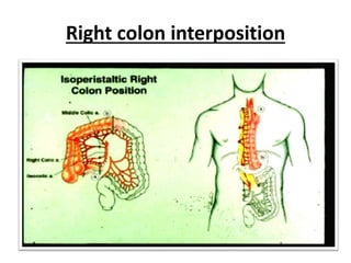 Conduits after esophagectomy for esophageal reconstruction | PPTX