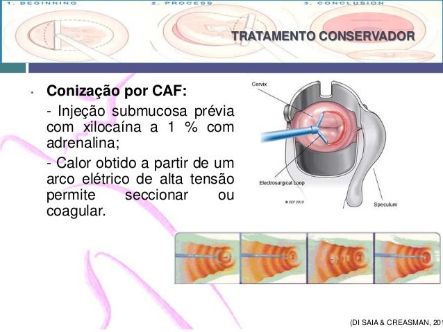Conduta no carcinoma microinvasivo do colo uterino lpjn