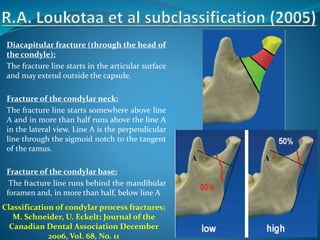 Condylar Process Of Mandible