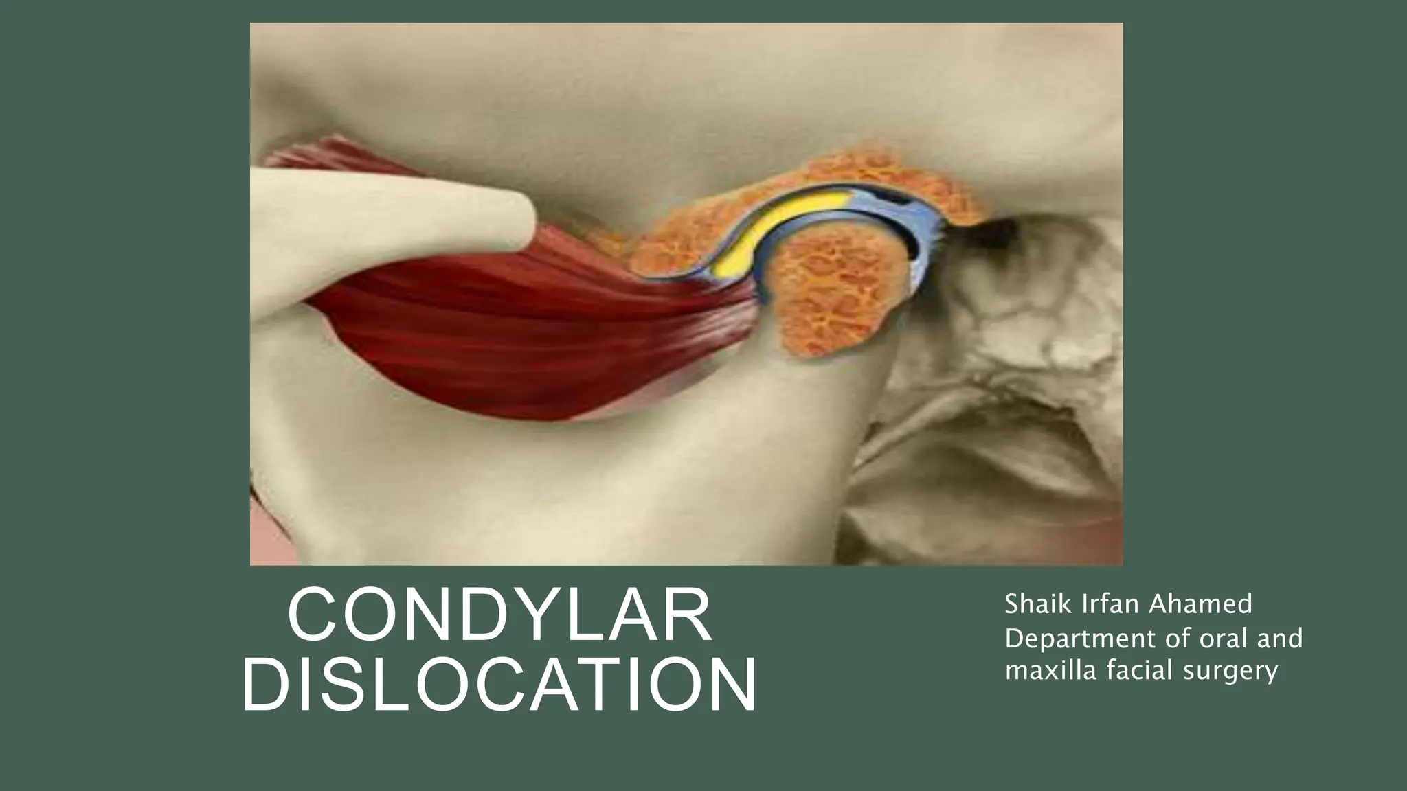 condylar dislocation- etiopathogenesis & treatment | PPTX