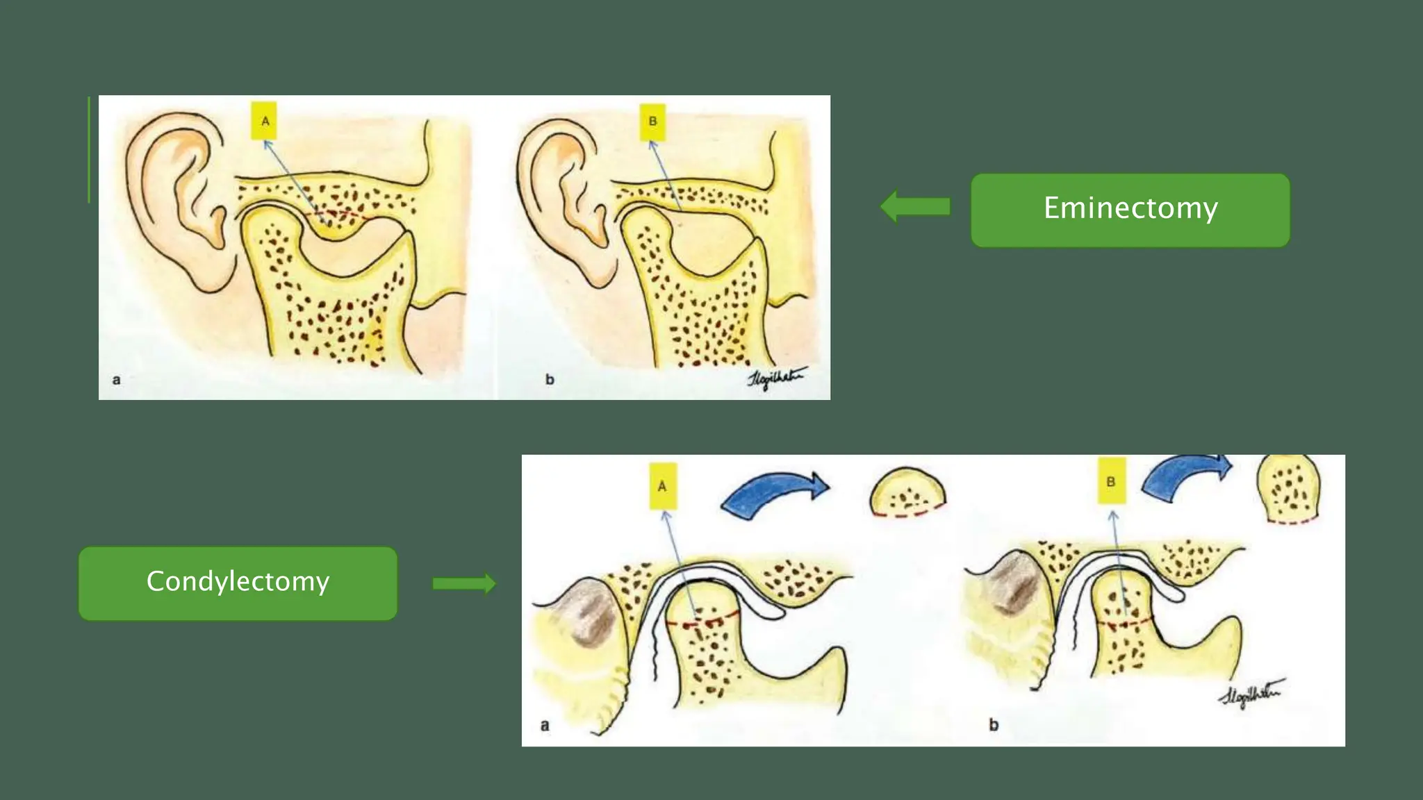 condylar dislocation- etiopathogenesis & treatment | PPTX