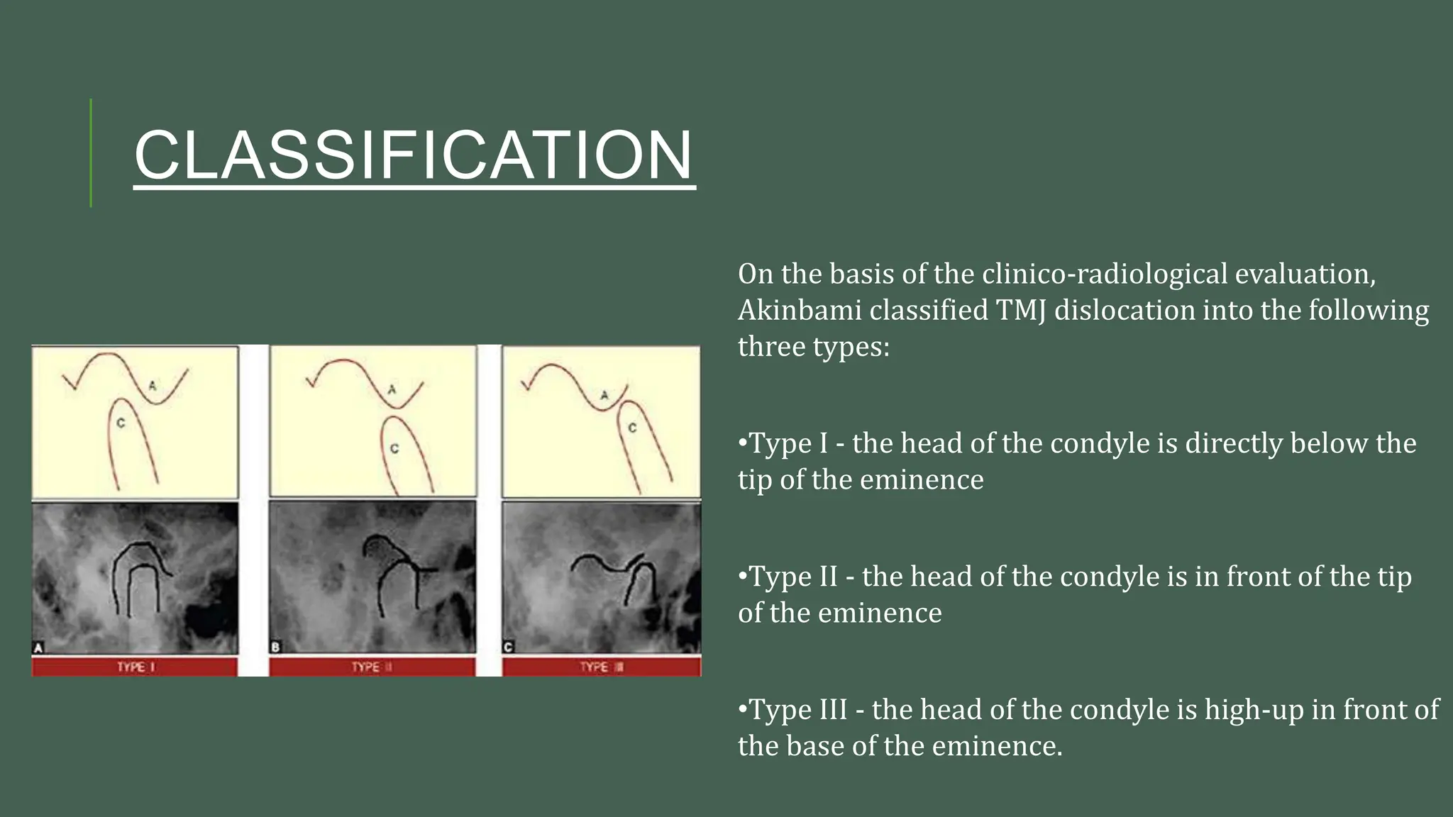 condylar dislocation- etiopathogenesis & treatment | PPTX