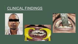 condylar dislocation- etiopathogenesis & treatment | PPTX