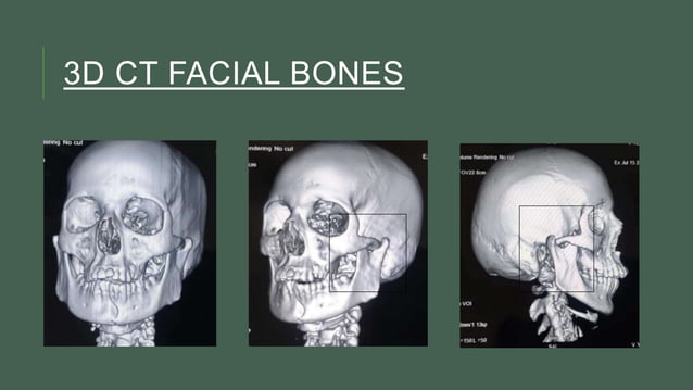 condylar dislocation- etiopathogenesis & treatment | PPTX