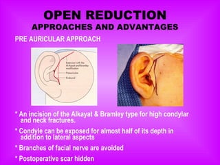 Condylar fracture | PPT