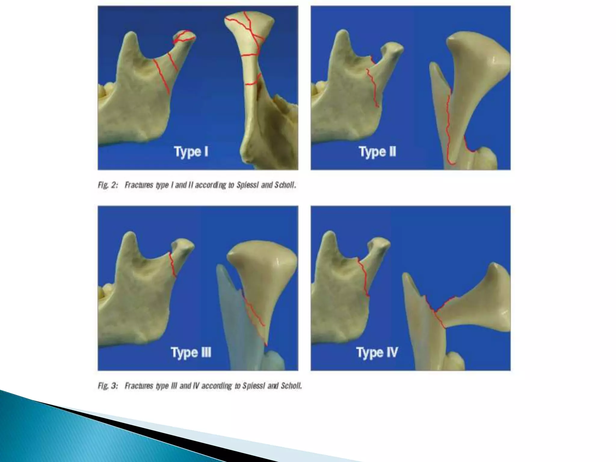 CONDYLAR FRACTURE.pptx