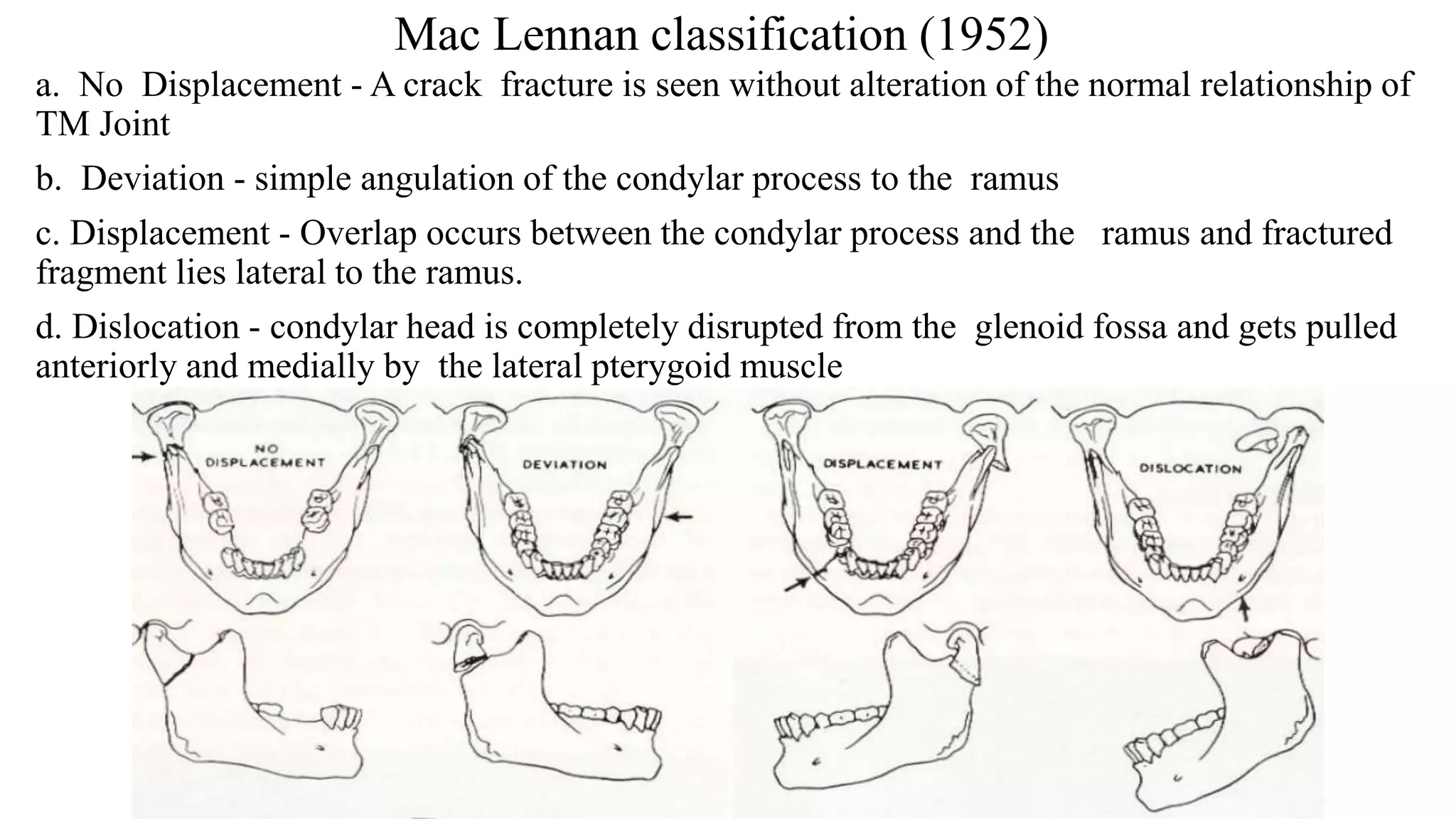 Condylar fracture.pptx