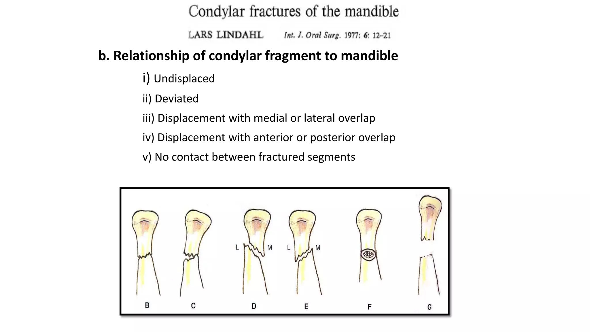 Condylar fracture.pptx