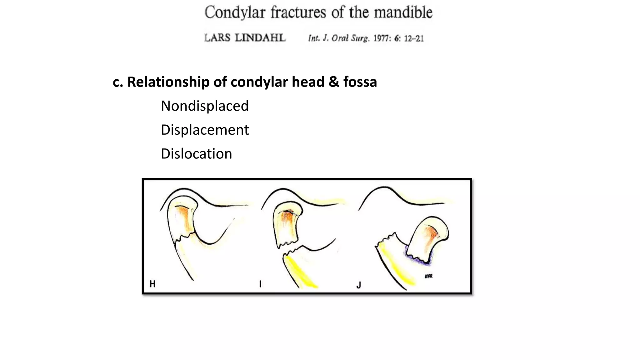 Condylar fracture.pptx