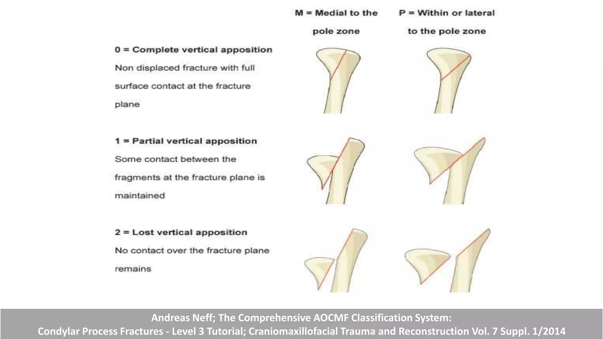 Condylar fracture.pptx