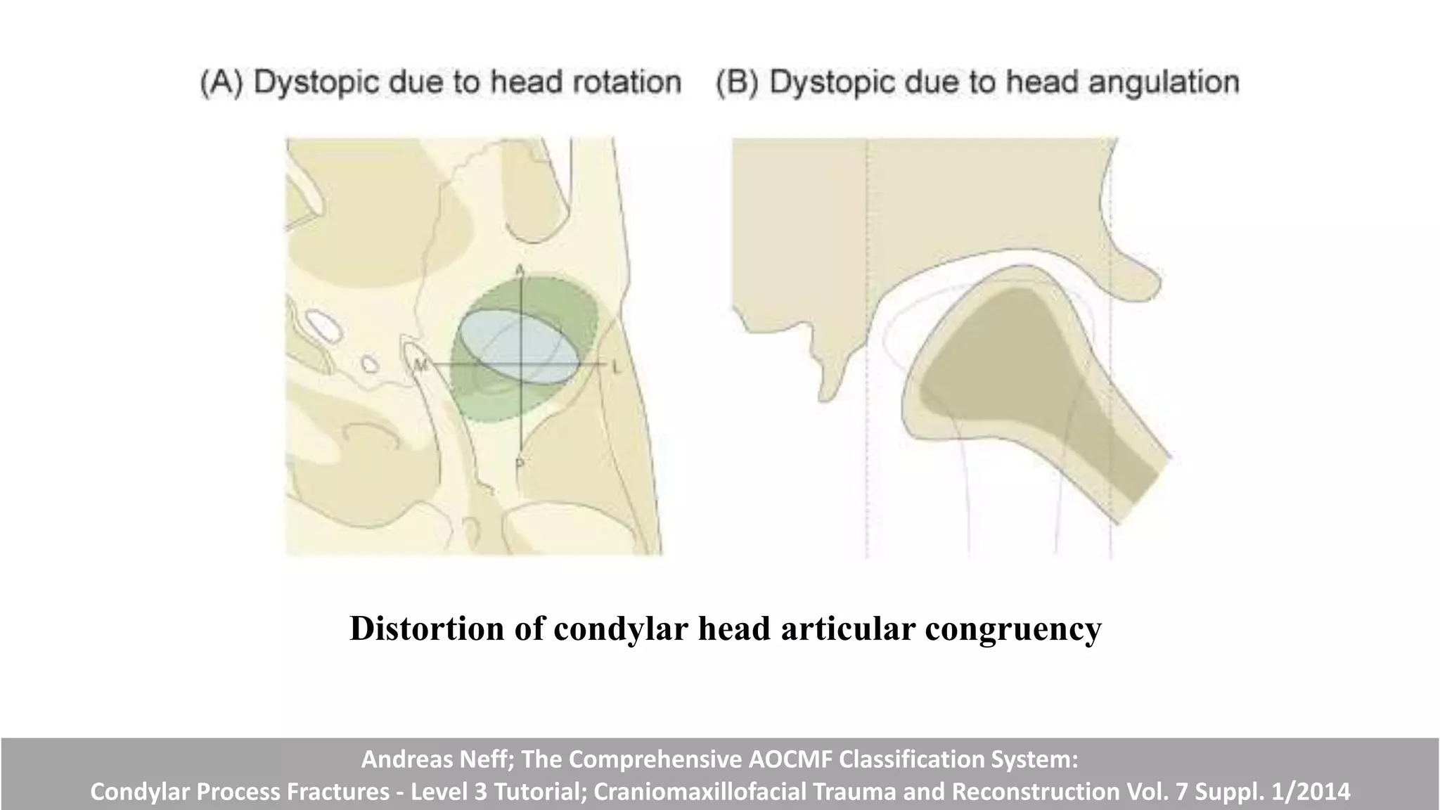 Condylar fracture.pptx