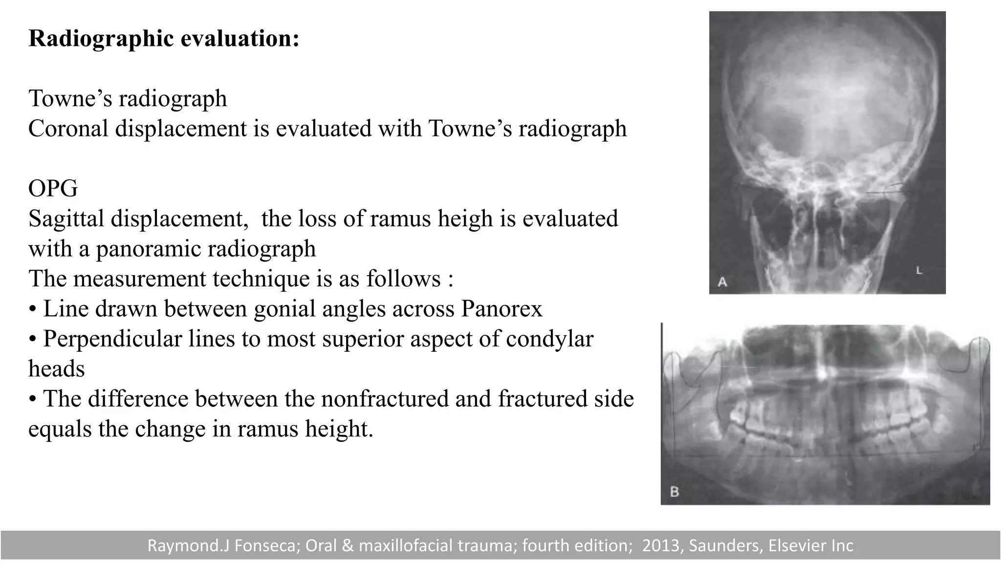 Condylar fracture.pptx