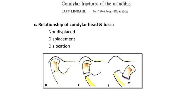 Condylar fracture.pptx