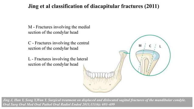 Condylar fracture.pptx