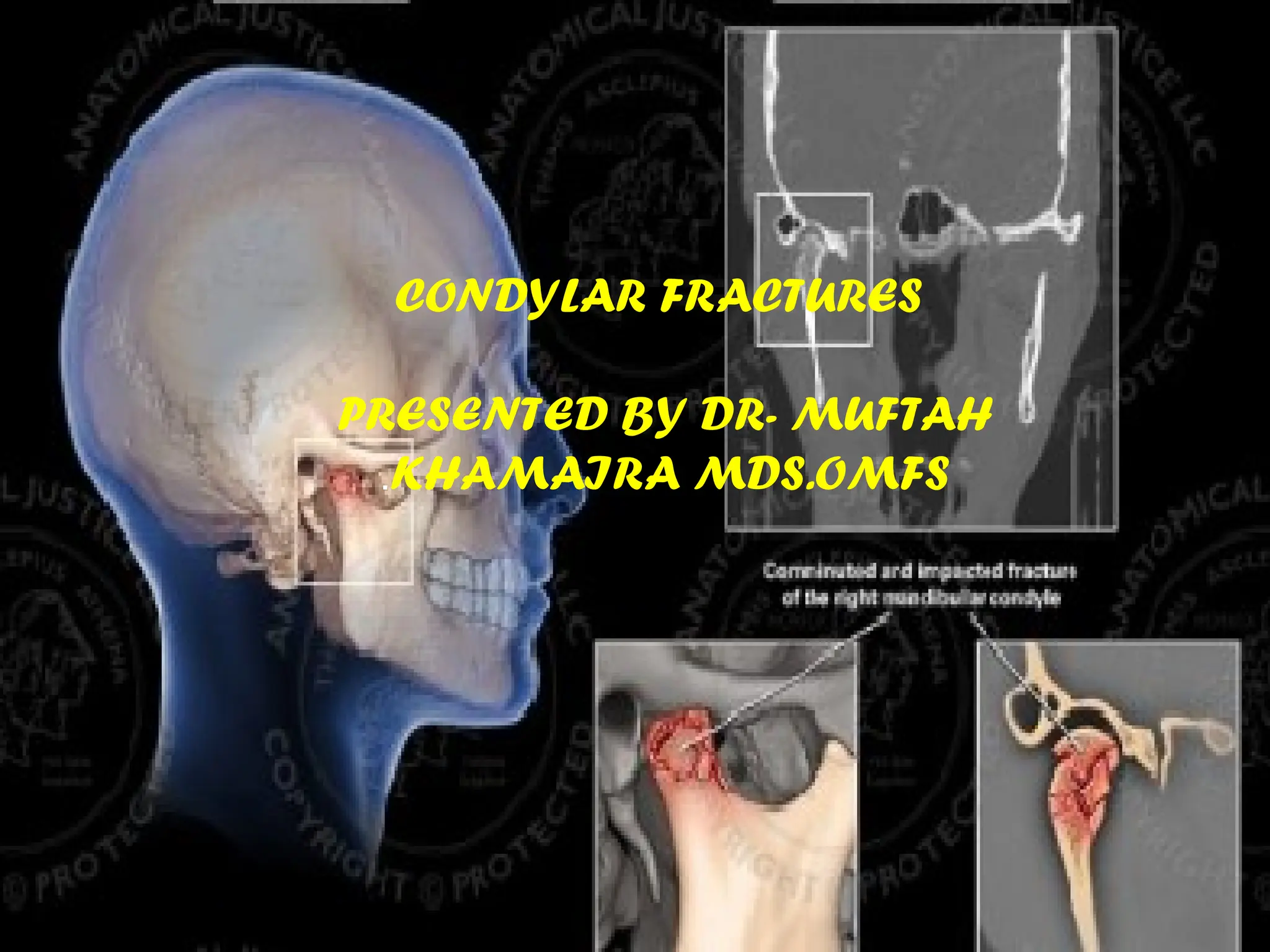 maxillofacia truma. managment of condylar fracture | PPTX