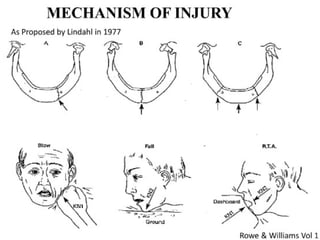 maxillofacia truma. managment of condylar fracture | PPTX