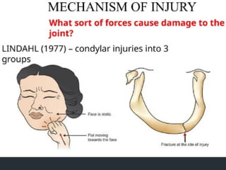 maxillofacia truma. managment of condylar fracture | PPTX