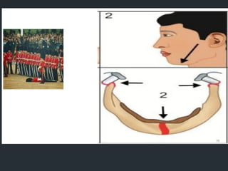 maxillofacia truma. managment of condylar fracture | PPTX