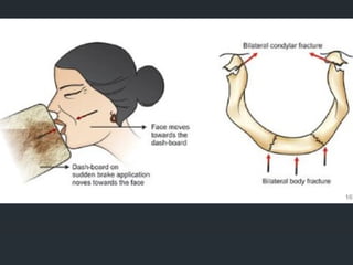 maxillofacia truma. managment of condylar fracture | PPTX