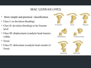 maxillofacia truma. managment of condylar fracture | PPTX