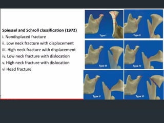 maxillofacia truma. managment of condylar fracture | PPTX