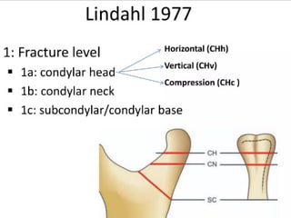 maxillofacia truma. managment of condylar fracture | PPTX