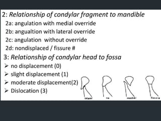 maxillofacia truma. managment of condylar fracture | PPTX
