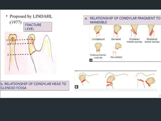 maxillofacia truma. managment of condylar fracture | PPTX