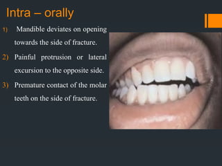 maxillofacia truma. managment of condylar fracture | PPTX