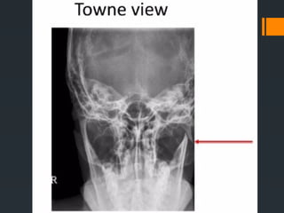 maxillofacia truma. managment of condylar fracture | PPTX