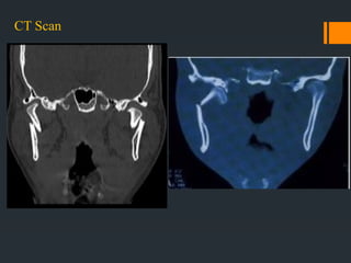 maxillofacia truma. managment of condylar fracture | PPTX