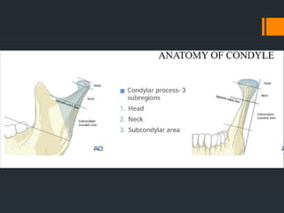 maxillofacia truma. managment of condylar fracture | PPTX