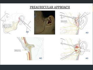 maxillofacia truma. managment of condylar fracture | PPTX