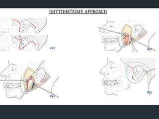 maxillofacia truma. managment of condylar fracture | PPTX