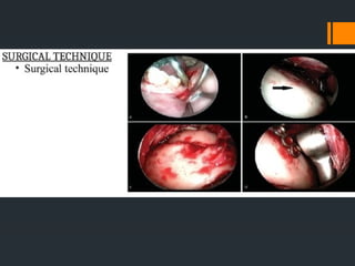 maxillofacia truma. managment of condylar fracture | PPTX