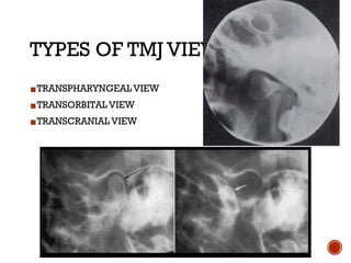 condylar fracture in oral and maxillofacial surgery | PPTX